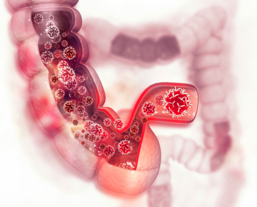 Síntomas y peligros de los pólipos de colon | Centro Digestivo GASTEA
